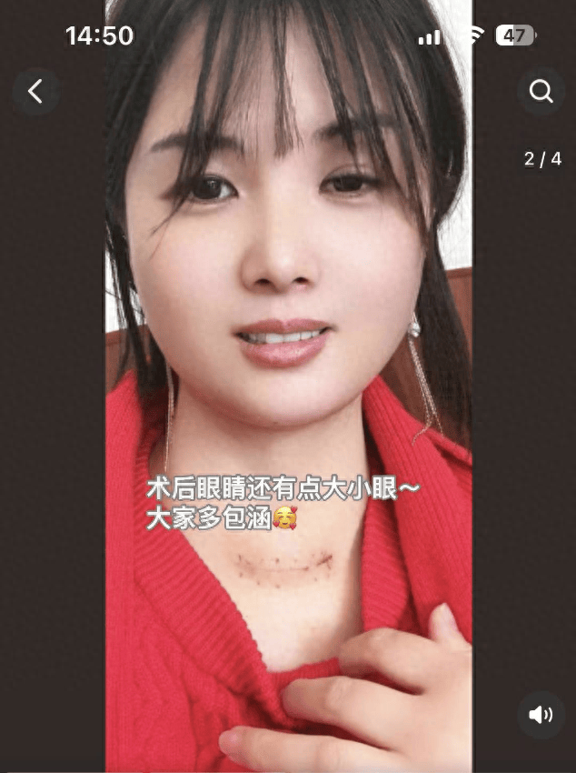 又一“顶流”女主播自曝患癌！这种癌女性比男性更高发，一定要小心_甲状腺_发病率_颈部