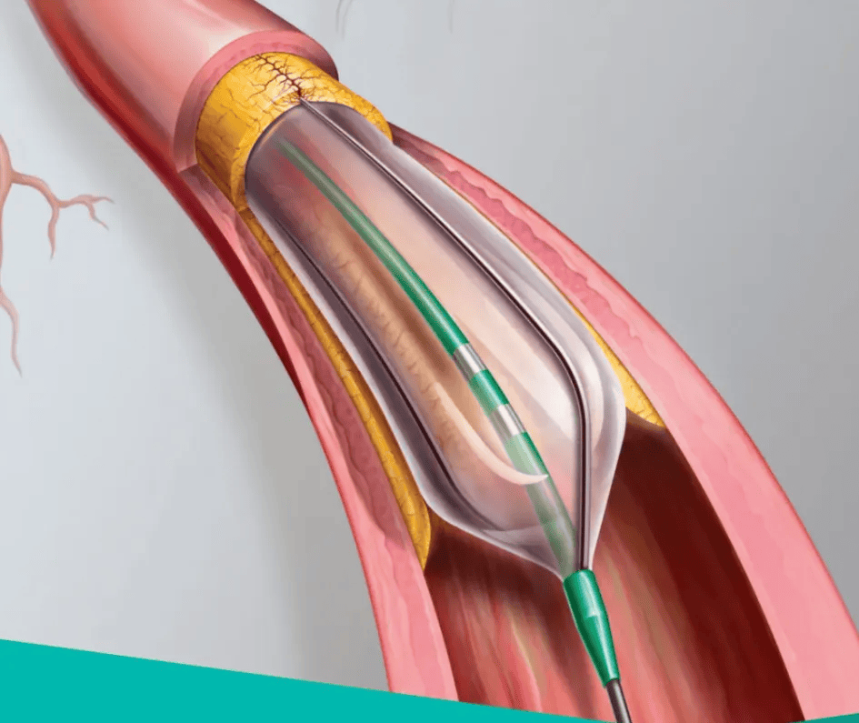 深度 | 血管介入医疗器械行业市场与产品分析报告（球囊篇）_临床_导管_患者