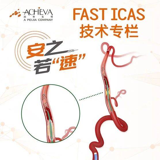 FAST ICAS技术治疗ICAS-LVO操作步骤详解_支架_扩张_导管
